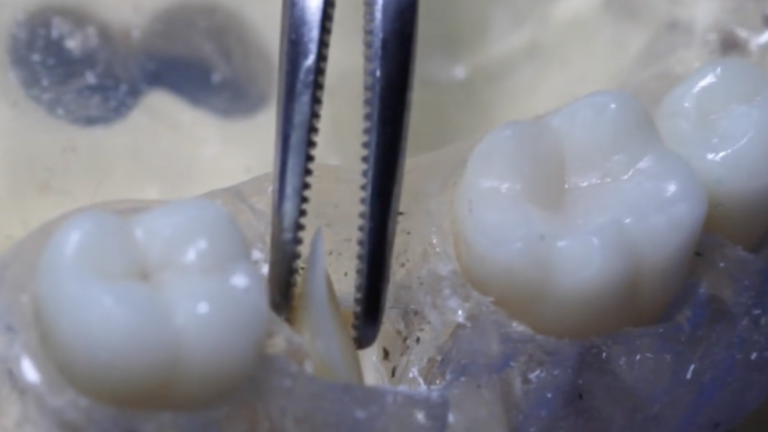 Surgical Extraction concepts for a mandibular molar – Video Library ...