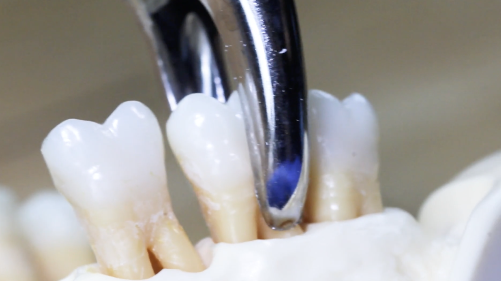 Surgical mandibular molar EXT on a model – Video Library – Implant ...