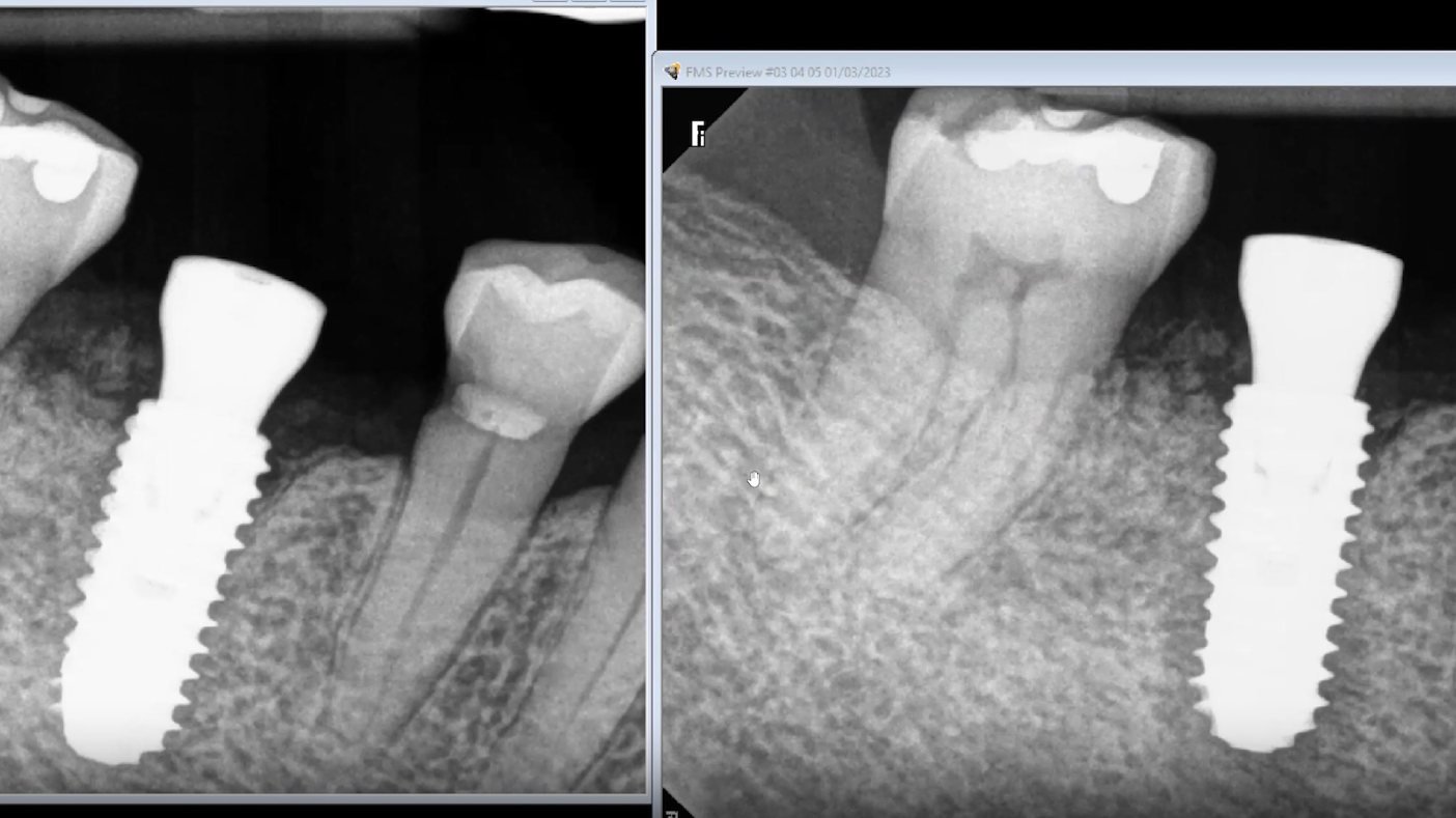Implant Surgery – Video Library – Implant Ninja Dojo